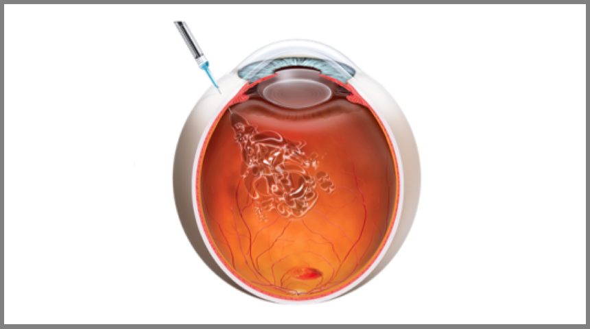 Servicios de oftalmologia en Rioverde - Visión10 - Dr. Alberto Ruiz